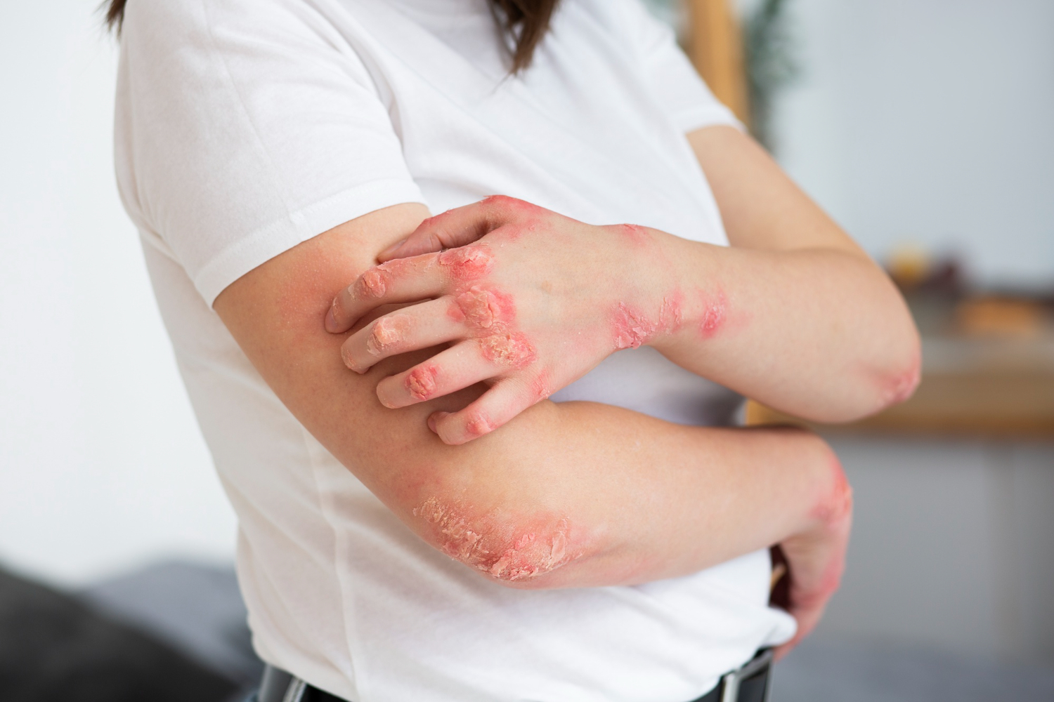 Tratamiento psoriasis: ¿Cuál es la mejor opción para mejorar la vida de ...